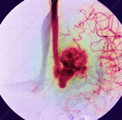 Blood Vessel Tumour Stock Image M1360117 Science Photo Library