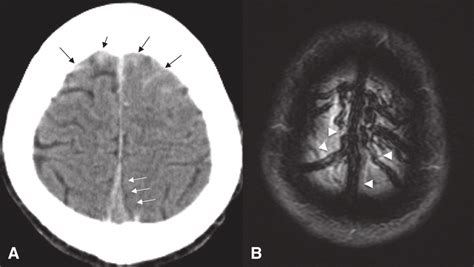 A Initial Ct Shows Local Subarachnoid Hemorrhage In Bilateral Frontal