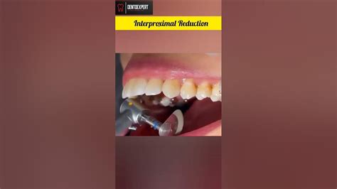 Interproximal Reduction For Space Gain Ortho Ipr Procedure Shorts