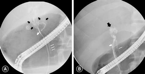 A B Cholangiogram Showing Opacification Of A Venous Structure Download Scientific Diagram