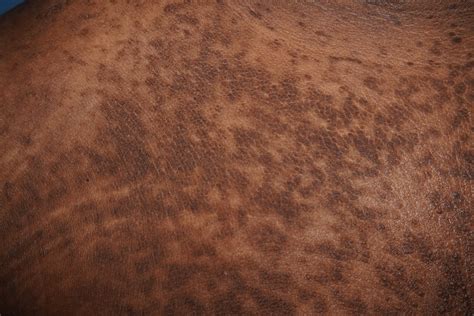 Confluent And Reticulated Papillomatosis Carp Digital Dermatology Atlas