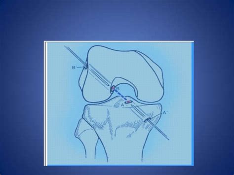 Derangement Knee Ppt