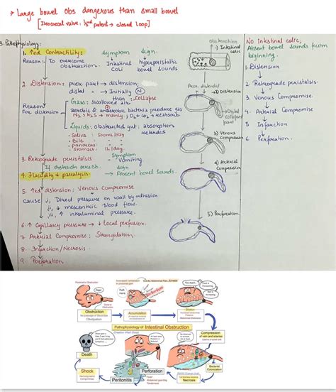 Intestinal Obstruction Definition Aetiopathogenic Types