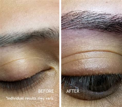 Microblading Radiance Medspa Avon Hartford Ct Hartford Ct Avon Ct