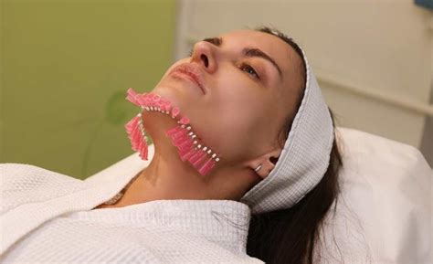 Pdo Threads For A Snatched Jawline Everything You Need To Know Diaminyaesthetics