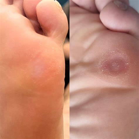 Verruca Treatment Lr Podiatry