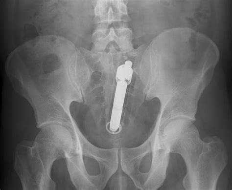 Top 10 X Ray Foreign Bodies • Litfl • Arcanum Veritas