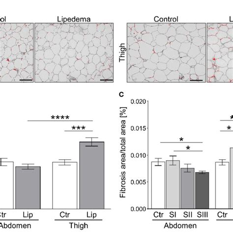 Adipocyte Hypertrophy Occurs In Later Stages Of Lipedema Progression
