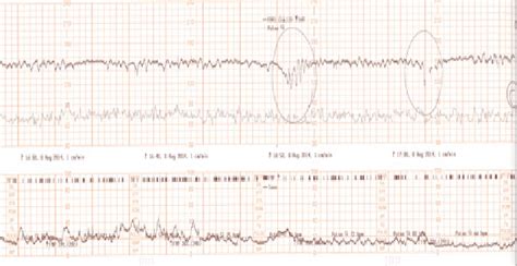 Ctg Block 2 Comment Non Reactive And Query Sinister Ctg Trial Of