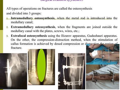 8 Fractures Dislocations Thermal Injuries Lecture 8pdf