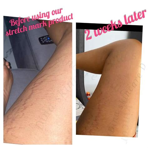 Skindna4u [피부노화주범] 3 자외선손상 색소침착 햇빛은 자외선 가시광선 적외선 등으로 구성되는데 그 중 자외선은 피부 색소침착이나 피부세포 노화의