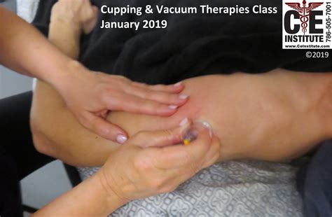 12 Ce Hour Orthopedic Cupping Computer Based Live Interactive Webinar