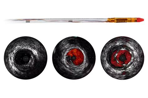 Intravascular Ultrasound Ivus Catheters Philips