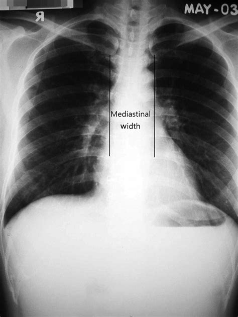 Measurement Of Mediastinal Width From Picture Archiving And