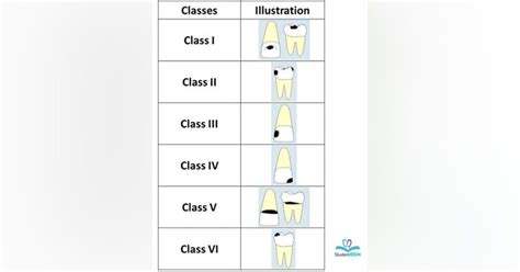 Understanding Dental Caries Classifications