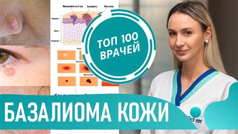 Базалиома фото лечение симптомы в начальной стадии
