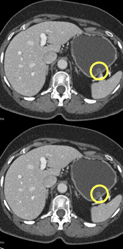 Gastrointestinal Learning Modules Ct Scanning