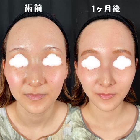 症例写真 鎌田 紀美子：tcb式小顔美肌再生 美容整形はtcb東京中央美容外科