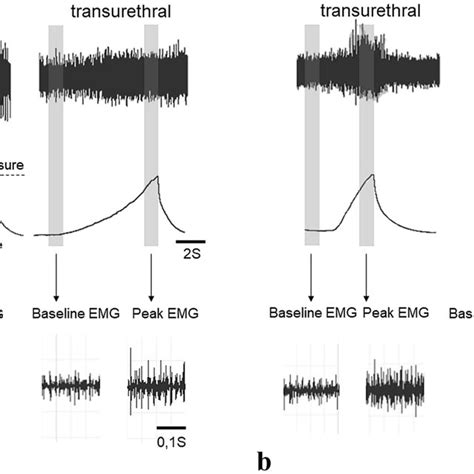 Representative Examples Of Lpp And Emg Recording Both Examples