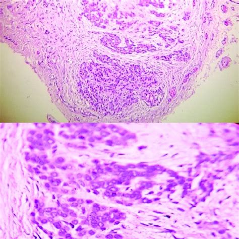 Pdf Love Signs Love For Glomus Tumor