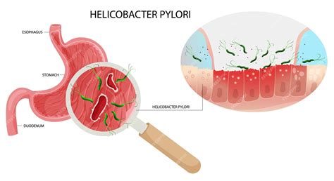 Premium Vector Helicobacter Pylori Infection In Stomach Ulcer Under