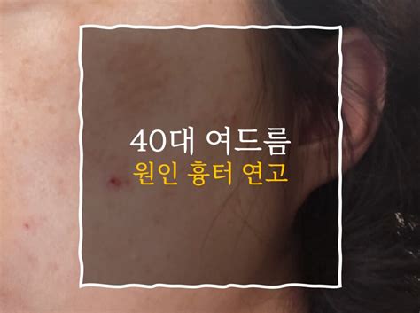 40대 여드름 원인 흉터 연고