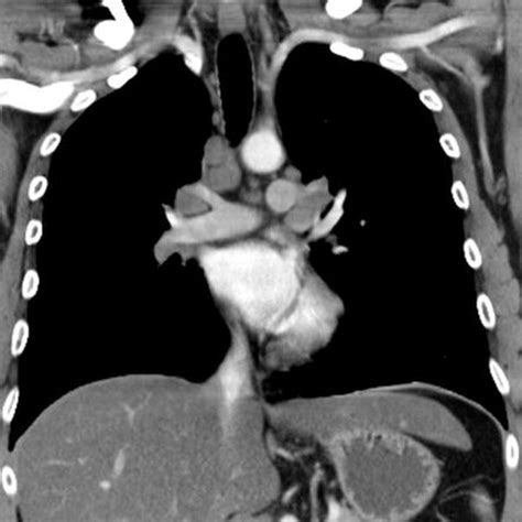 Ithy Decoding Your Chest Scan Understanding Adenomegaly Bronchial