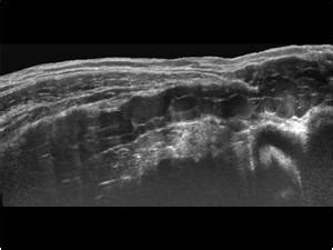 Gynaecology Vagina Case Miscellaneous Vagina And External Genitalia Ultrasound Cases