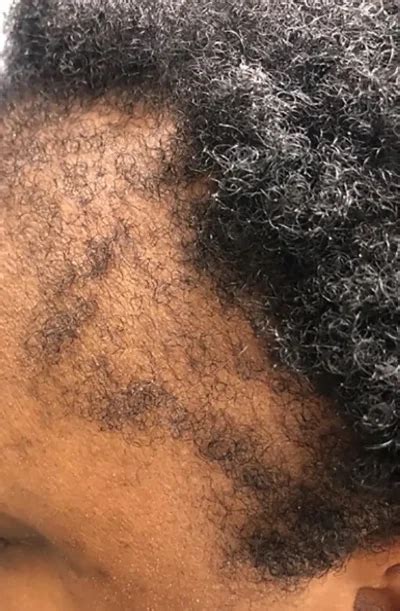 Traction Alopecia Causes Stages And Treatment Options