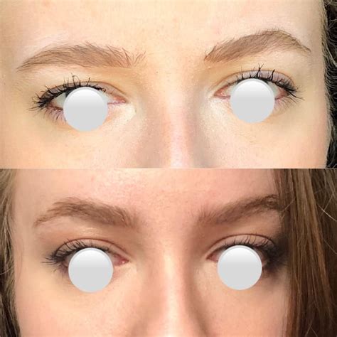 Botox Brow Lift What You Should Know Nova Plastic Sur