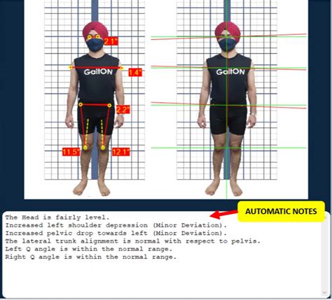 Digital Posture Analysis System For Clinical At Best Price In New