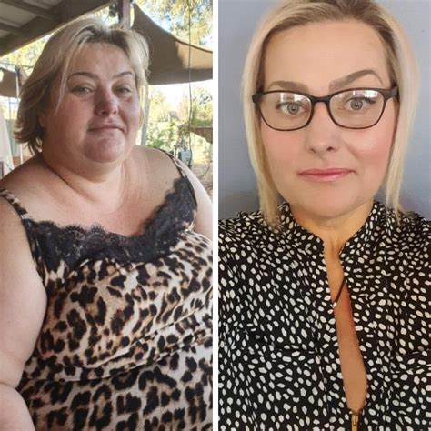 Advance Surgical Bariatric Surgeon Perth Weight Loss