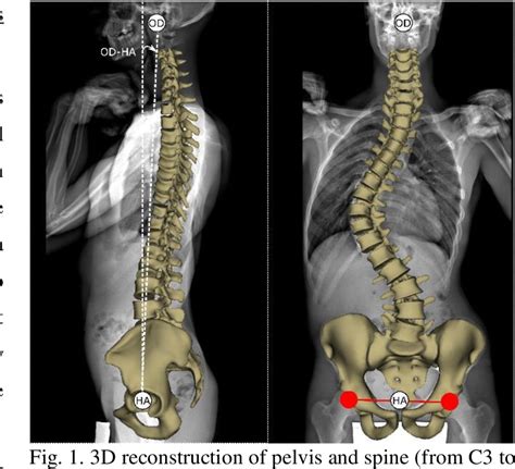 Figure 1 From Global Sagittal Alignment And Proximal Junctional