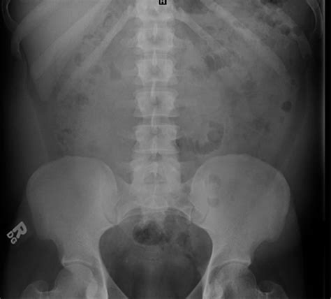 Abdomen Quiz Flashcards Quizlet