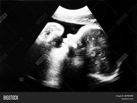 Fetus 7 Month Womb Image And Photo Free Trial Bigstock