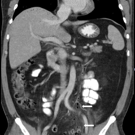 Areas Of Inflammation And Fat Stranding Surround The Sigmoid Colon