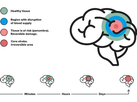 Tests And Diagnosis Of Stroke