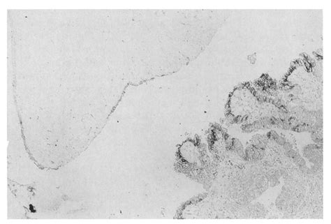 Immunoperoxidase Staining Of A Serous Ovarian Tumor With Borderline