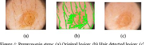 Figure 1 From Automated Lesion Border Detection Of Dermoscopy Images Using Spectral Clustering