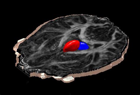 Figure 76 From Segmentation Of Diffusion Weighted Mri Using The Level