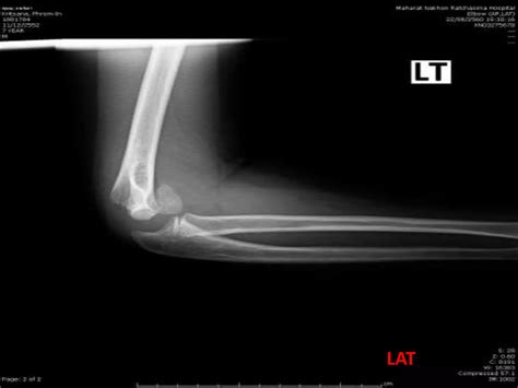 Case Discussion Lateral Condyle Fracture Ppt