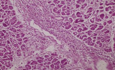 Photomicrograph Showing Chronic Pancreatitis With Fibrosis Of The