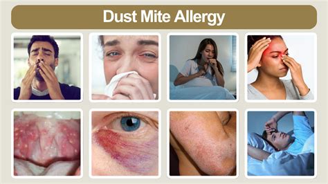 Dust Mite Allergy 12 Symptoms You Shouldnt Ignore