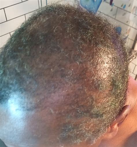 2ddr Best Product For Hair Loss 2 Deoxy D Ribose 2ddr Gel