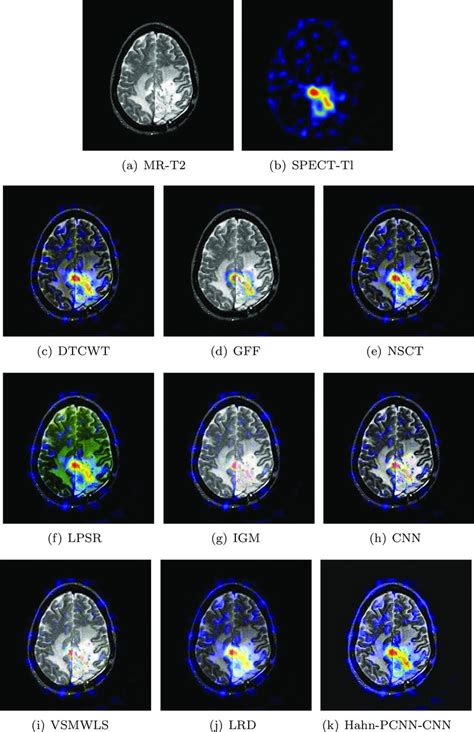 The First Set Of Fused MRI SPECT Images From Methods On Glioma Download Scientific Diagram
