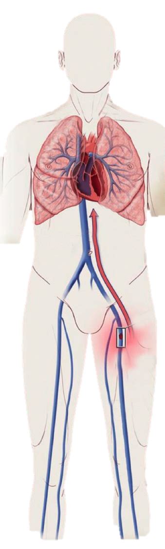Embolia Pulmonar Celso Neves