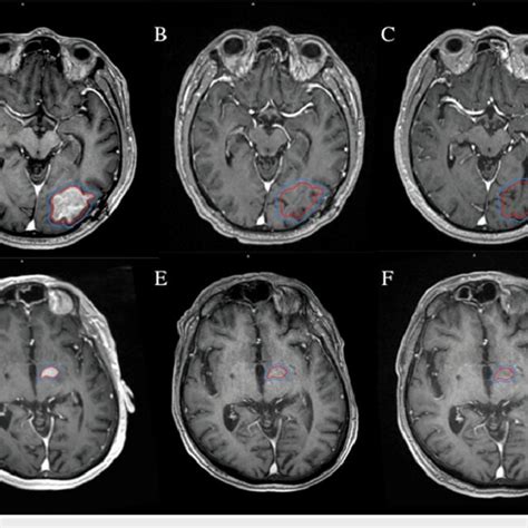 Representative Axial T1 Post Contrast Mri Images Demonstrating Target