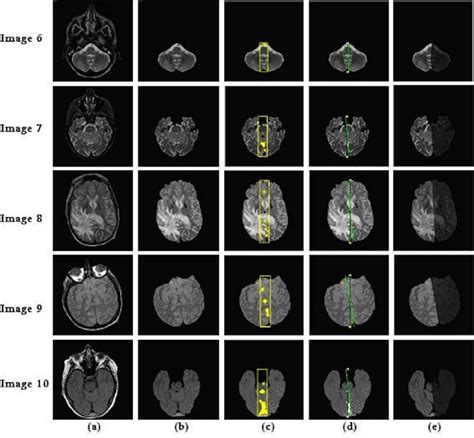 Results Of Msp Detection And Hemisphere Segmentation In T2 And