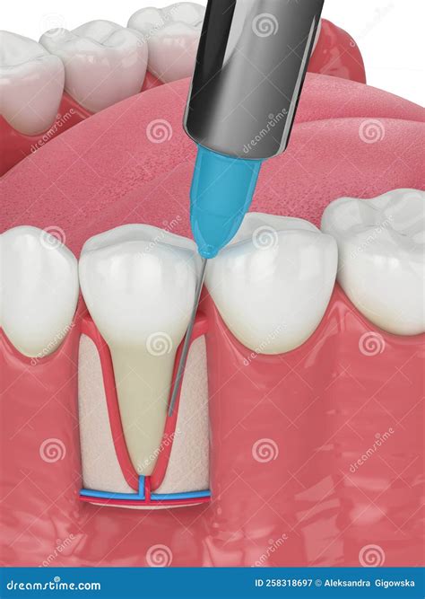 3d Render Of Human Jaw With Intraligamentary Anesthesia Procedure Stock