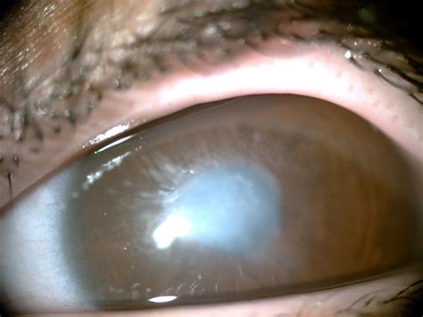 Successful Treatment Of Corneal Hypertrophic Scar In Hurler Syndrome
